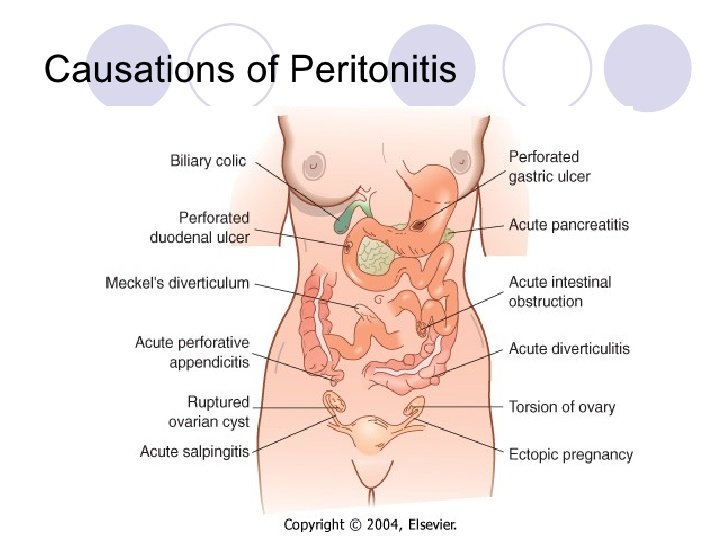Peritonitis