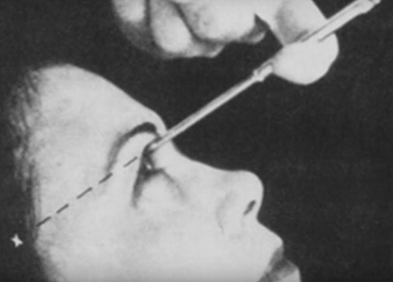 Famous Lobotomy Patients