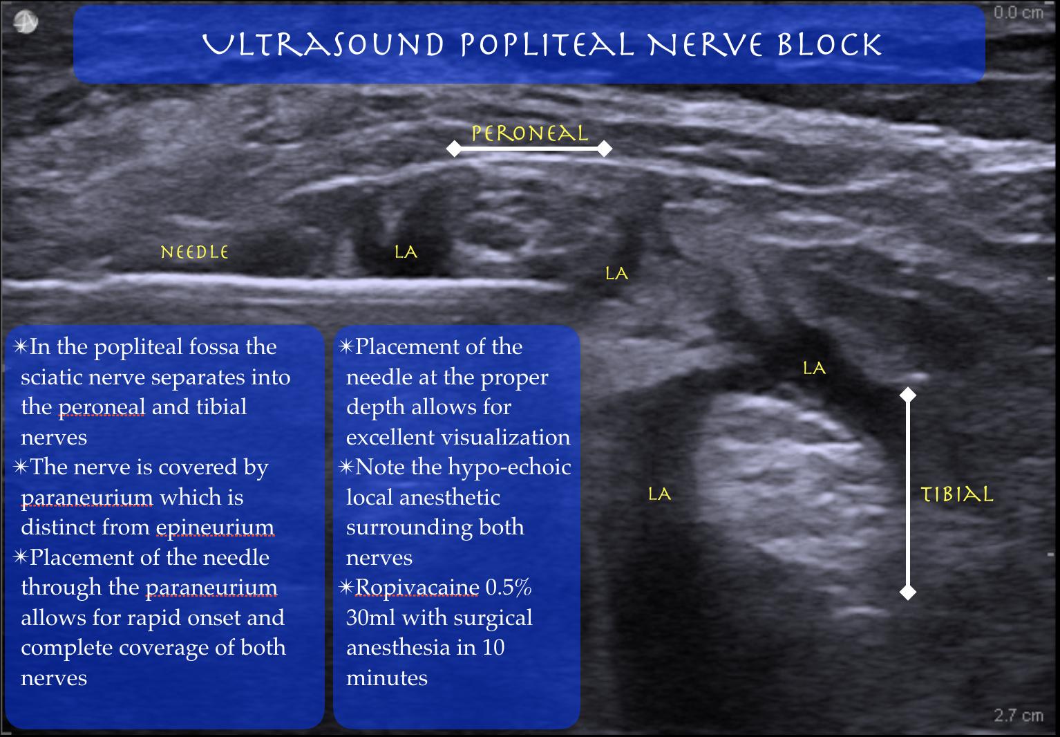 Popliteal Nerve Block Ultrasound