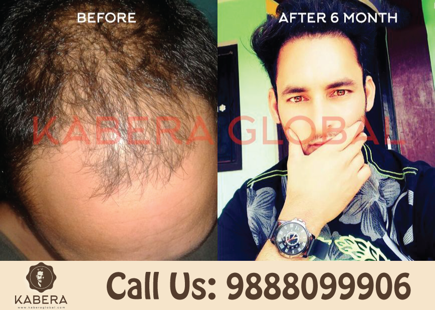 Top 145 Kabera Global Hair Transplant Reviews Polarrunningexpeditions