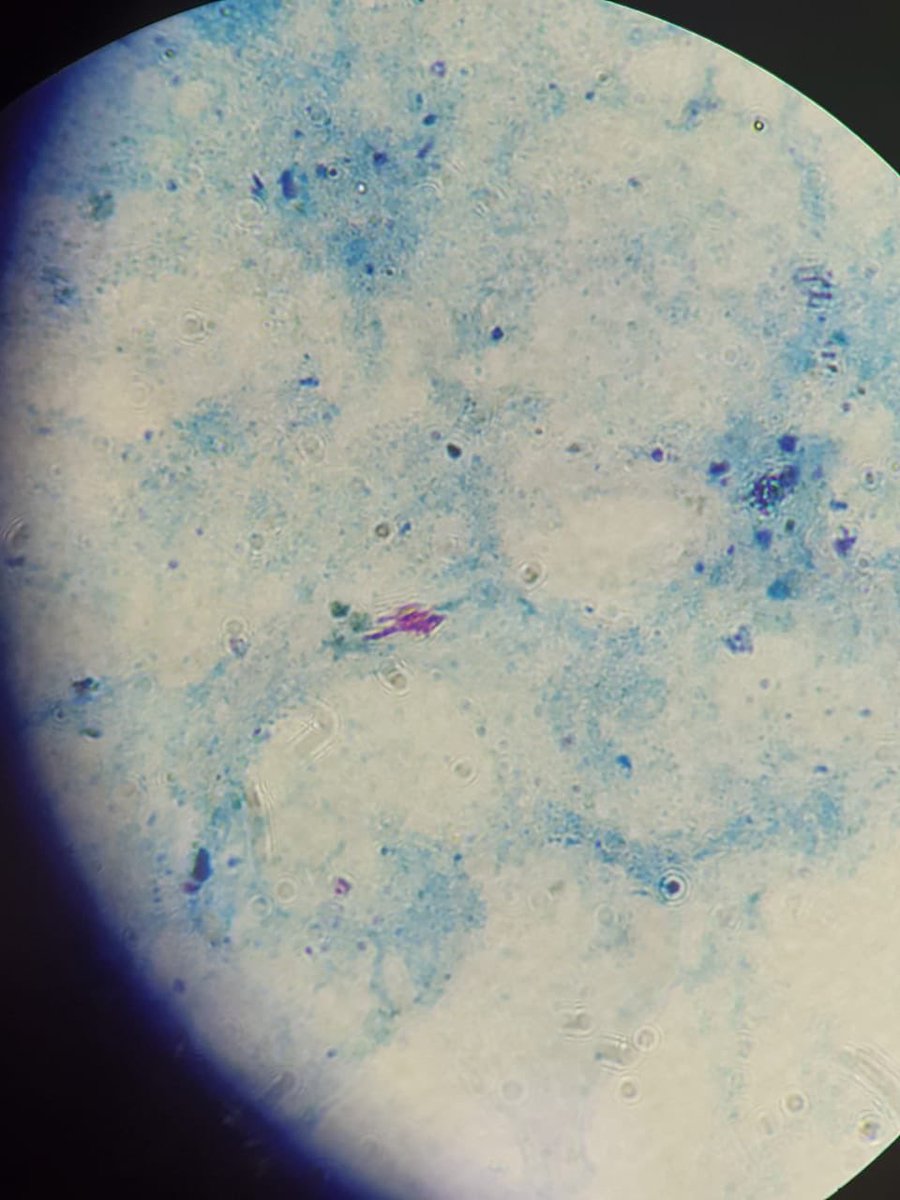 العينة smear from positive culture لمريض درن هذه العينة تم عملها على ...