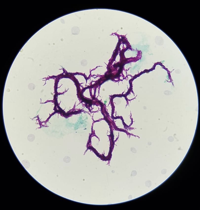 العينة smear from positive culture لمريض درن هذه العينة تم عملها على ...