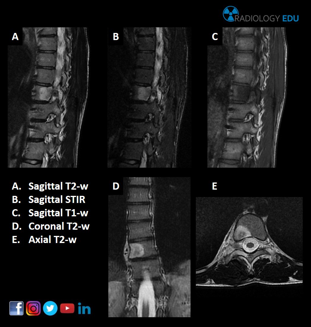 Osteoid Osteoma Spine Mri