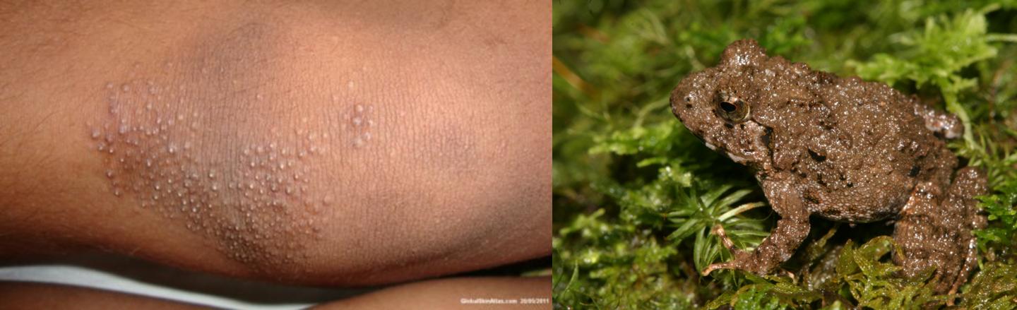 Follicular Hyperkeratosis Vitamin A Deficiency