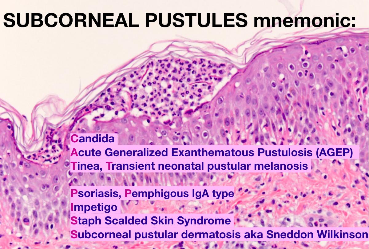 Acute Generalized Exanthematous Pustulosis Histology