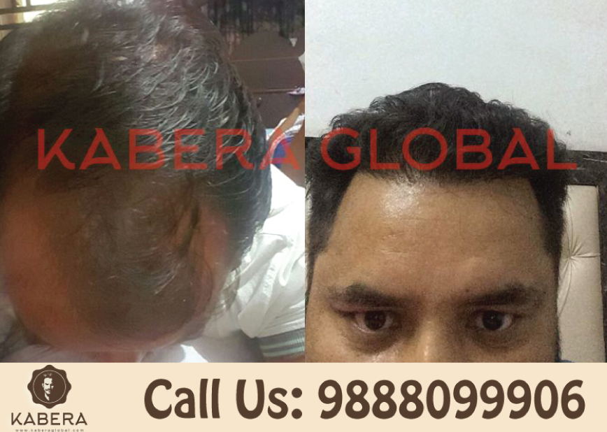 Top 145 Kabera Global Hair Transplant Reviews Polarrunningexpeditions