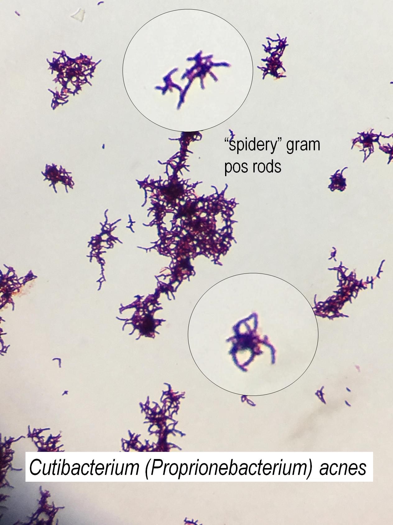 Propionibacterium Acnes Gram Stain