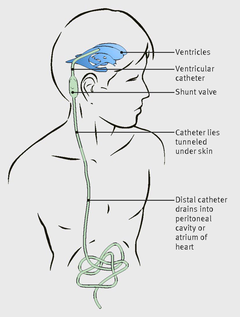 اليوم موضوعنا عن ارتفاع الضغط داخل الجمجمة مجهول السبب Idiopathic ...