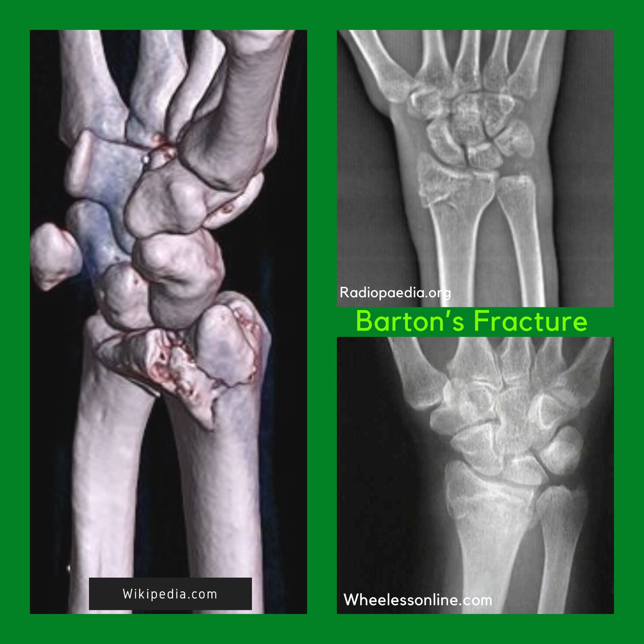 Bartons Fracture Lateral View Of Barton Fracture. | Download