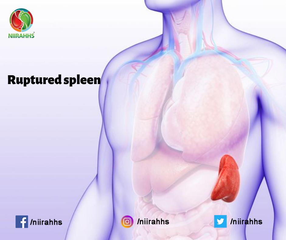 Ruptured Spleen