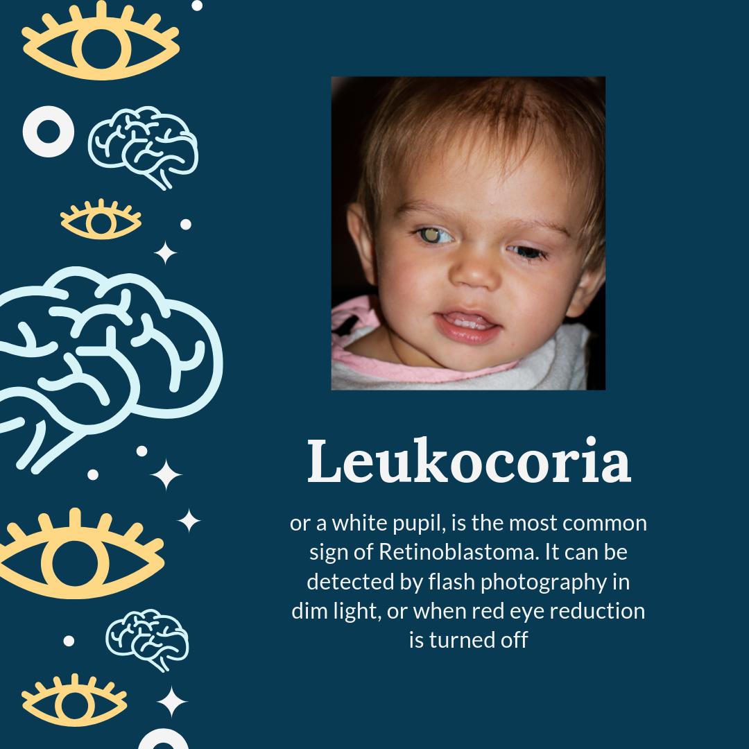 Leukocoria In Infants