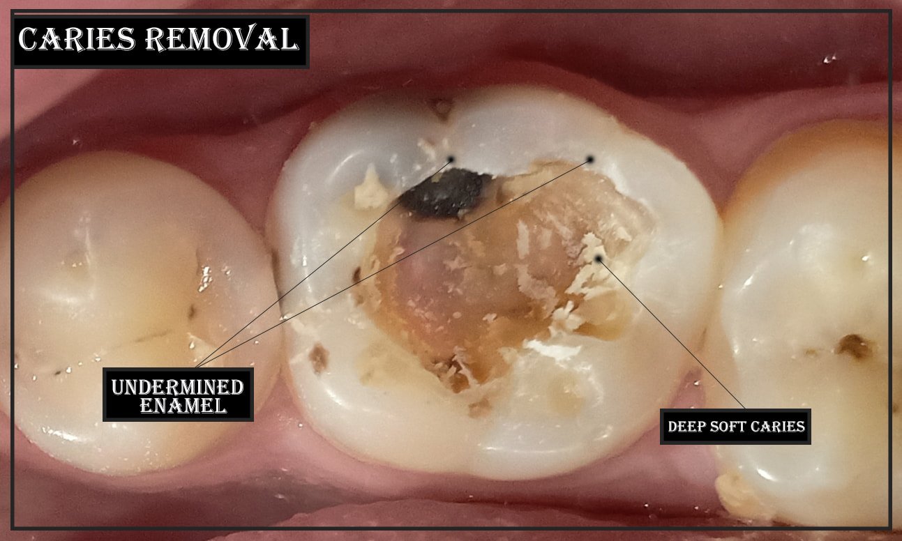 Caries Removal Vital Tooth With Deep Carious Lesions The Ideal