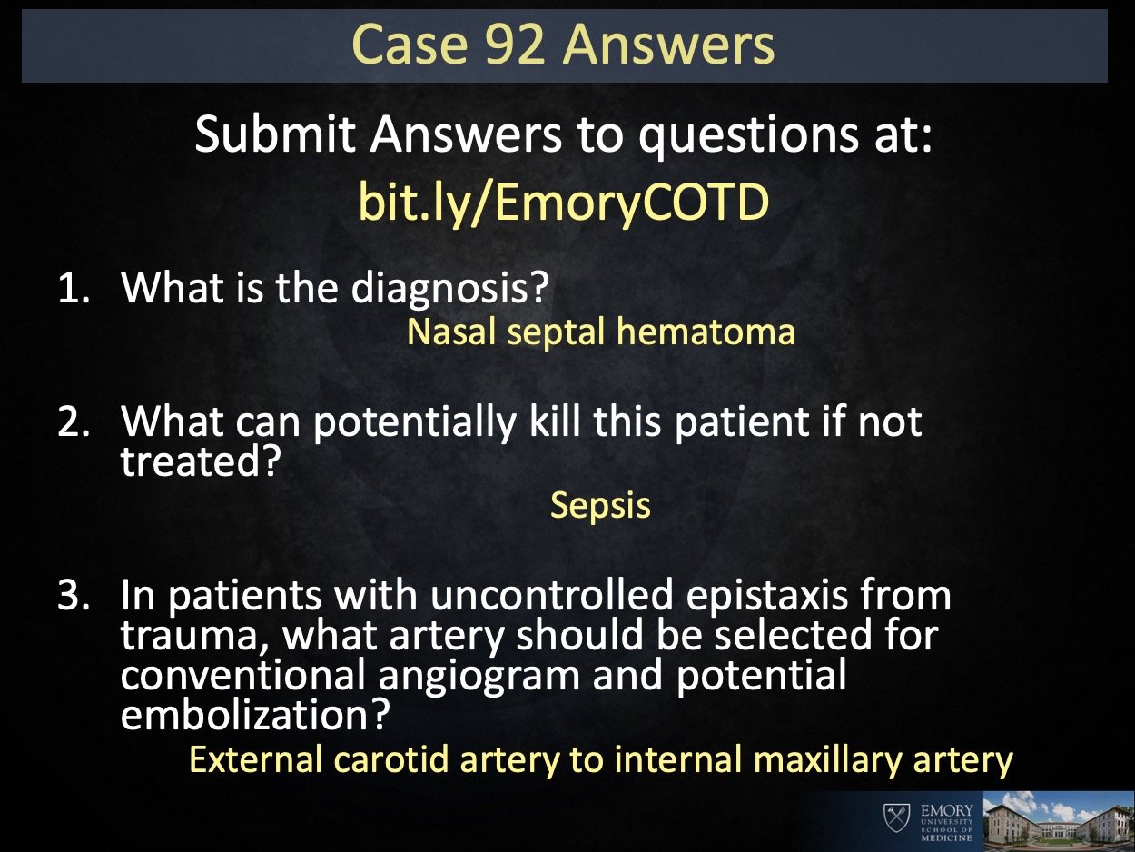 Twin Embolization Syndrome
