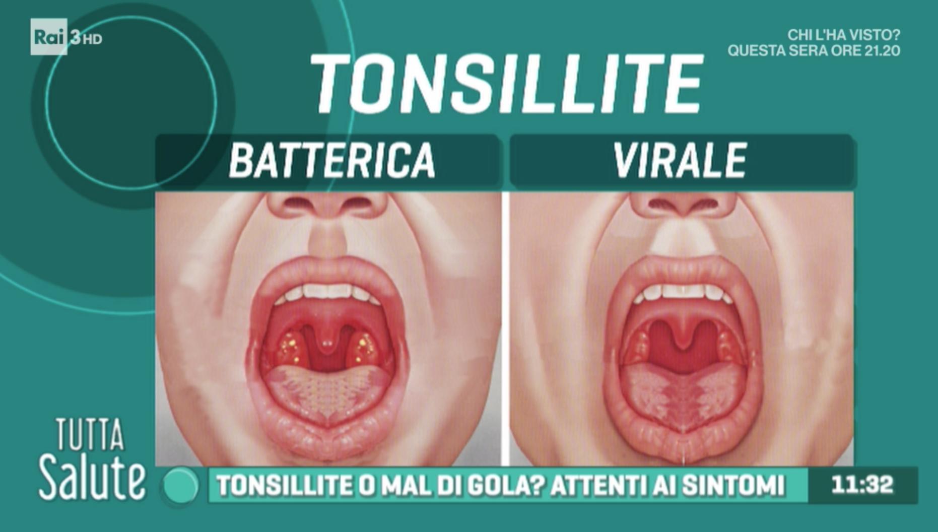 Tonsillite Batterica Negli Adulti