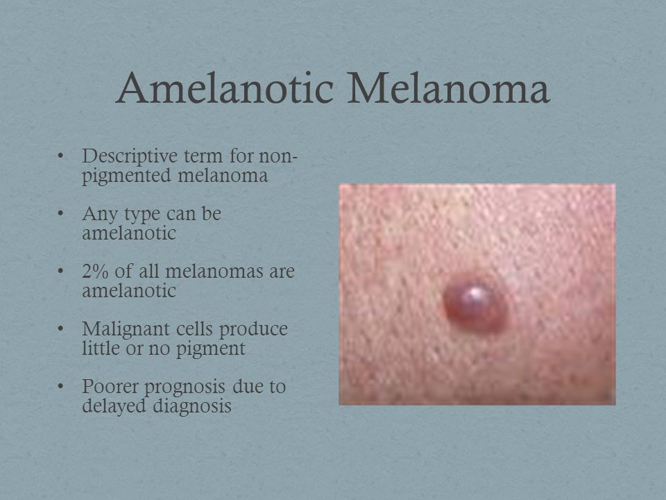 Nodular Melanoma Flesh Colored