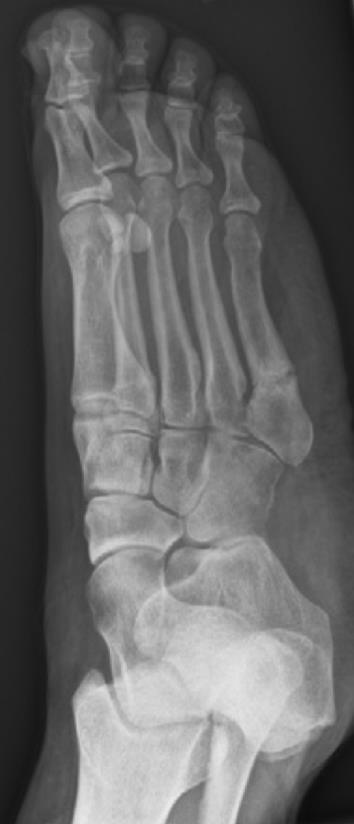 Jones Fracture Orthobullets