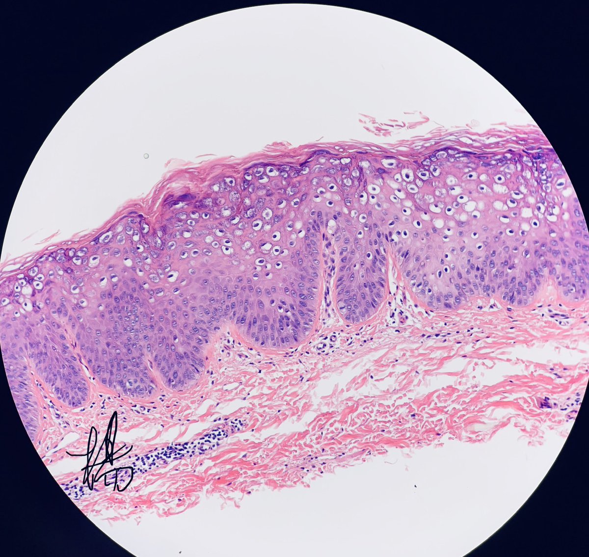 Verruca Plana Histology