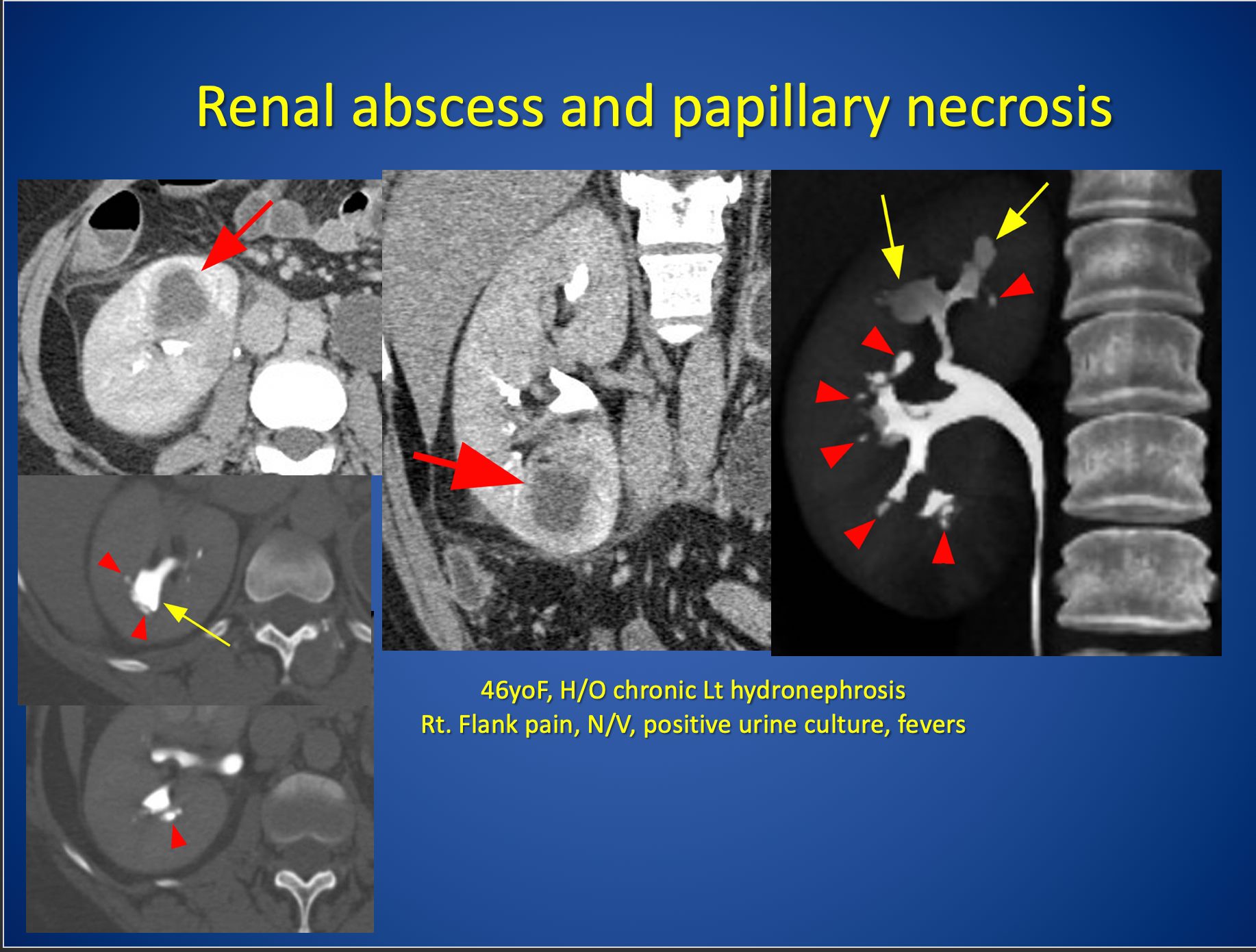 Renal Papillary Necrosis Urine