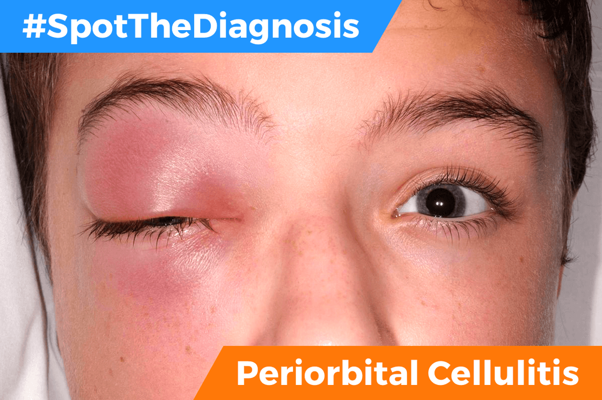 Preseptal Cellulitis Vs Orbital Cellulitis