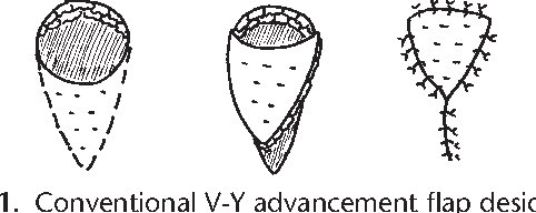 V Y Advancement Flap