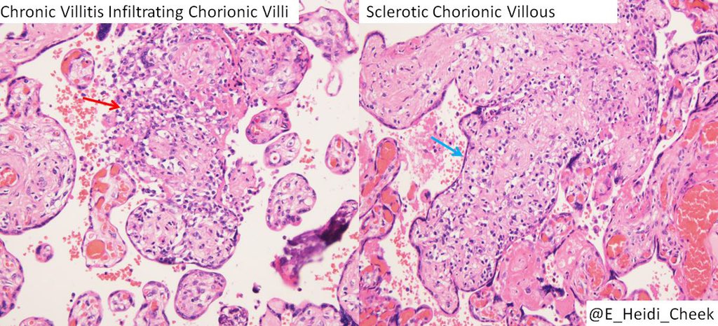 Chorionic Villi