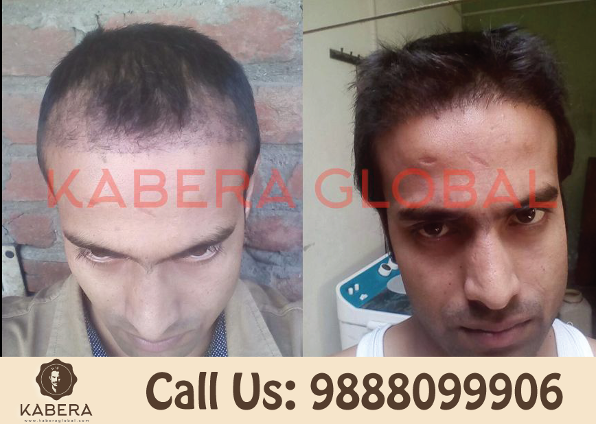 Top 145 Kabera Global Hair Transplant Reviews Polarrunningexpeditions