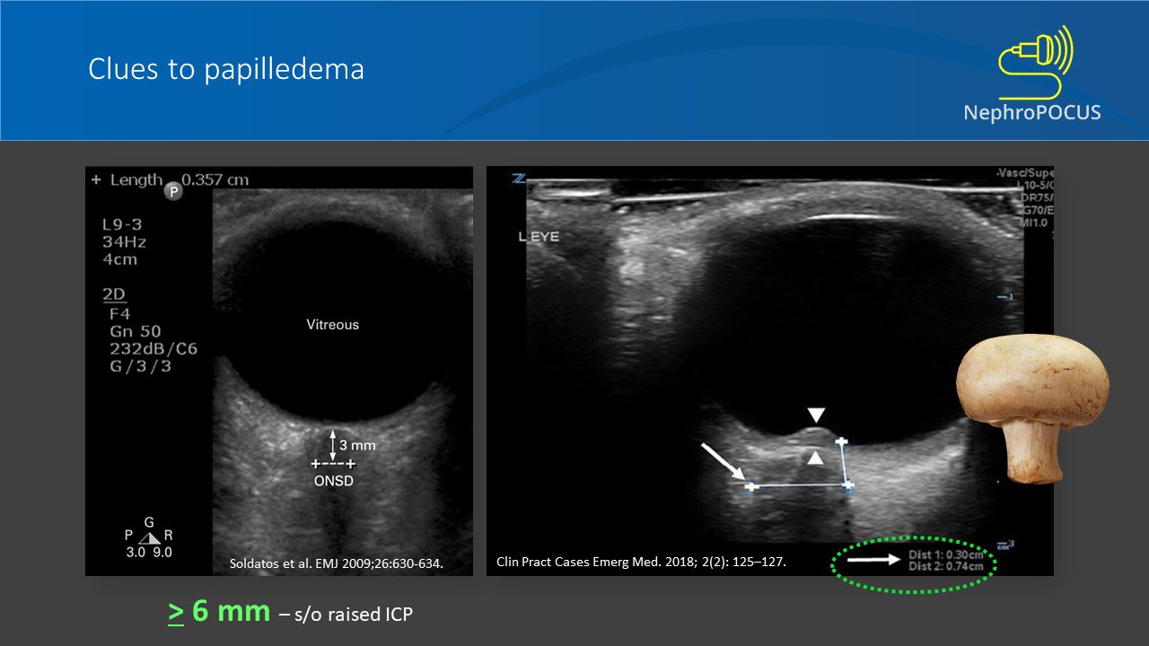 Optic Nerve Sheath Diameter