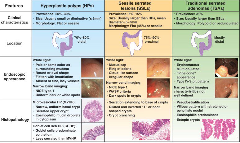 Serrated Polyp