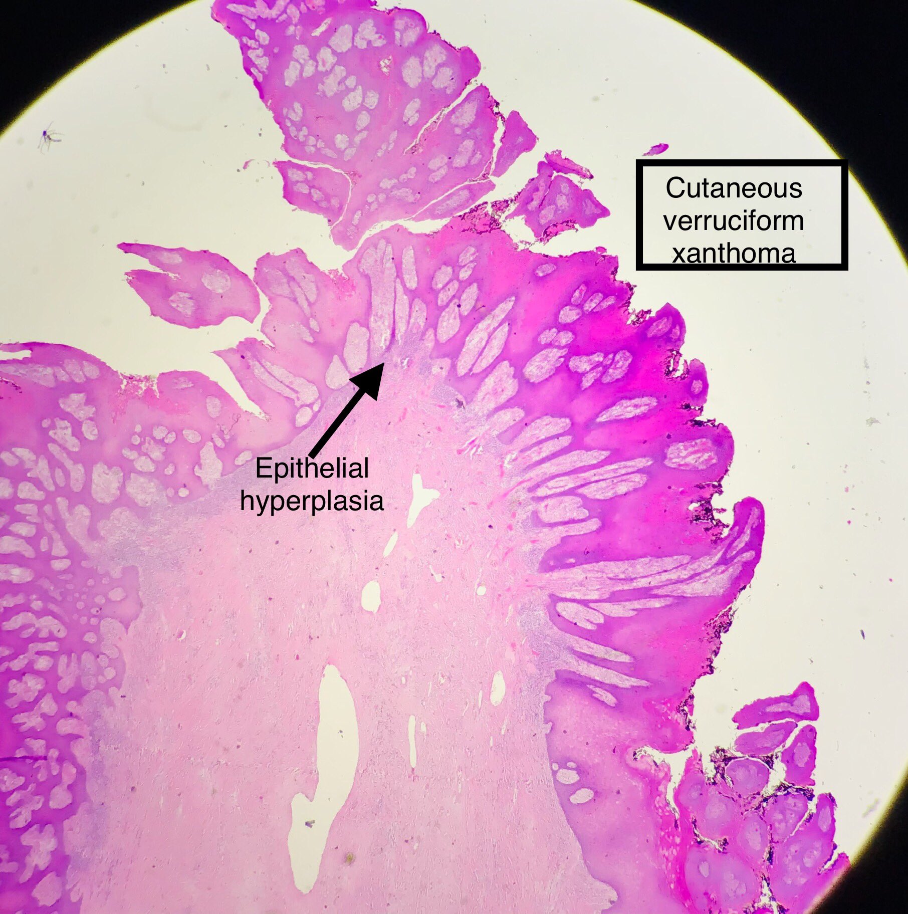 Verruciform Xanthoma Histology