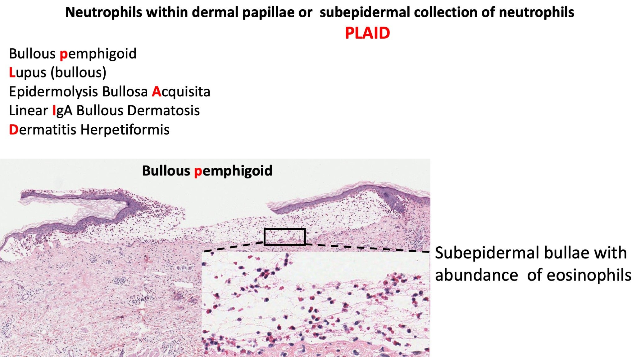 Epidermolysis Bullosa Acquisita Histology