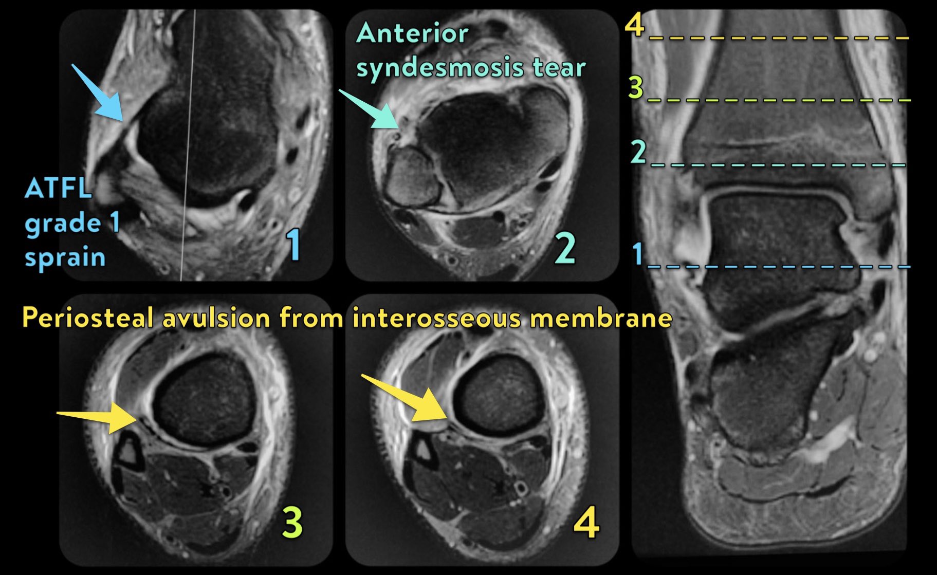 Ankle Sprain Mri