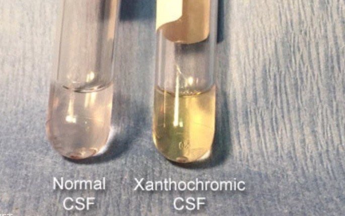 Cerebrospinal Fluid Color