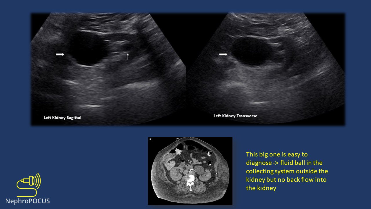 Extrarenal Pelvis