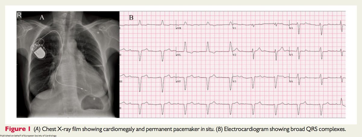 Cardiomegaly