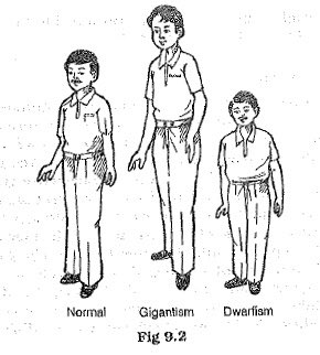 Gigantism In Children