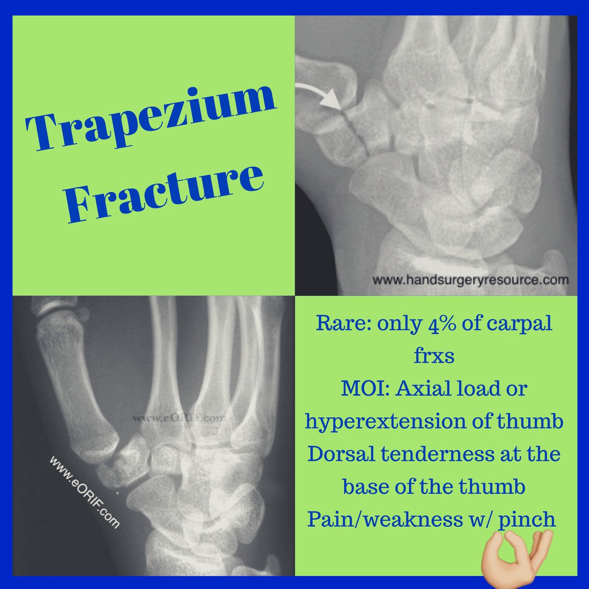 Trapezium Bone