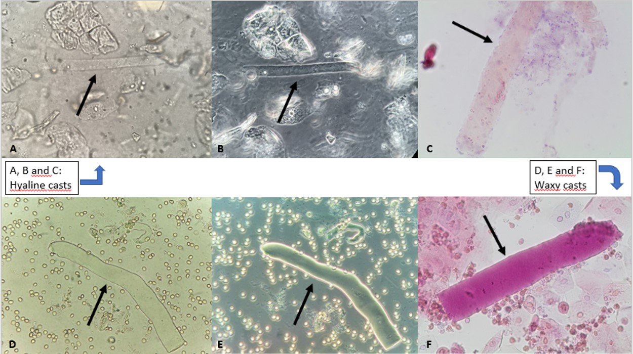 Hyaline Cast In Urine Casts | EClinpath