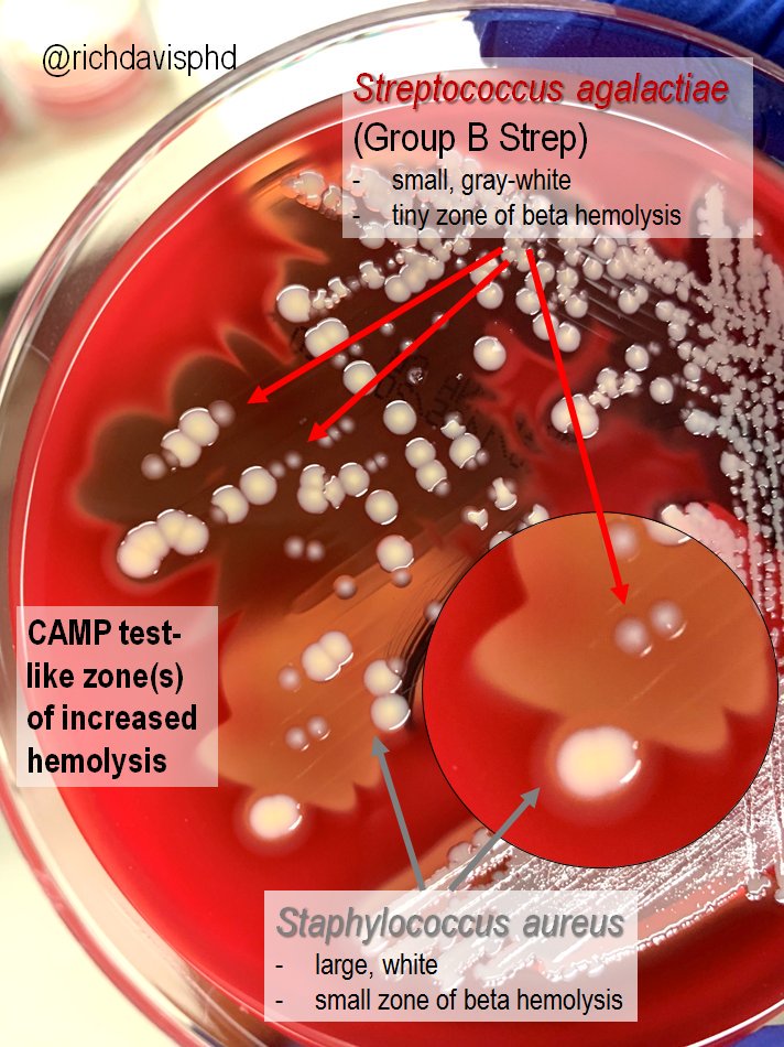 Beta Hemolysis Staphylococcus Aureus