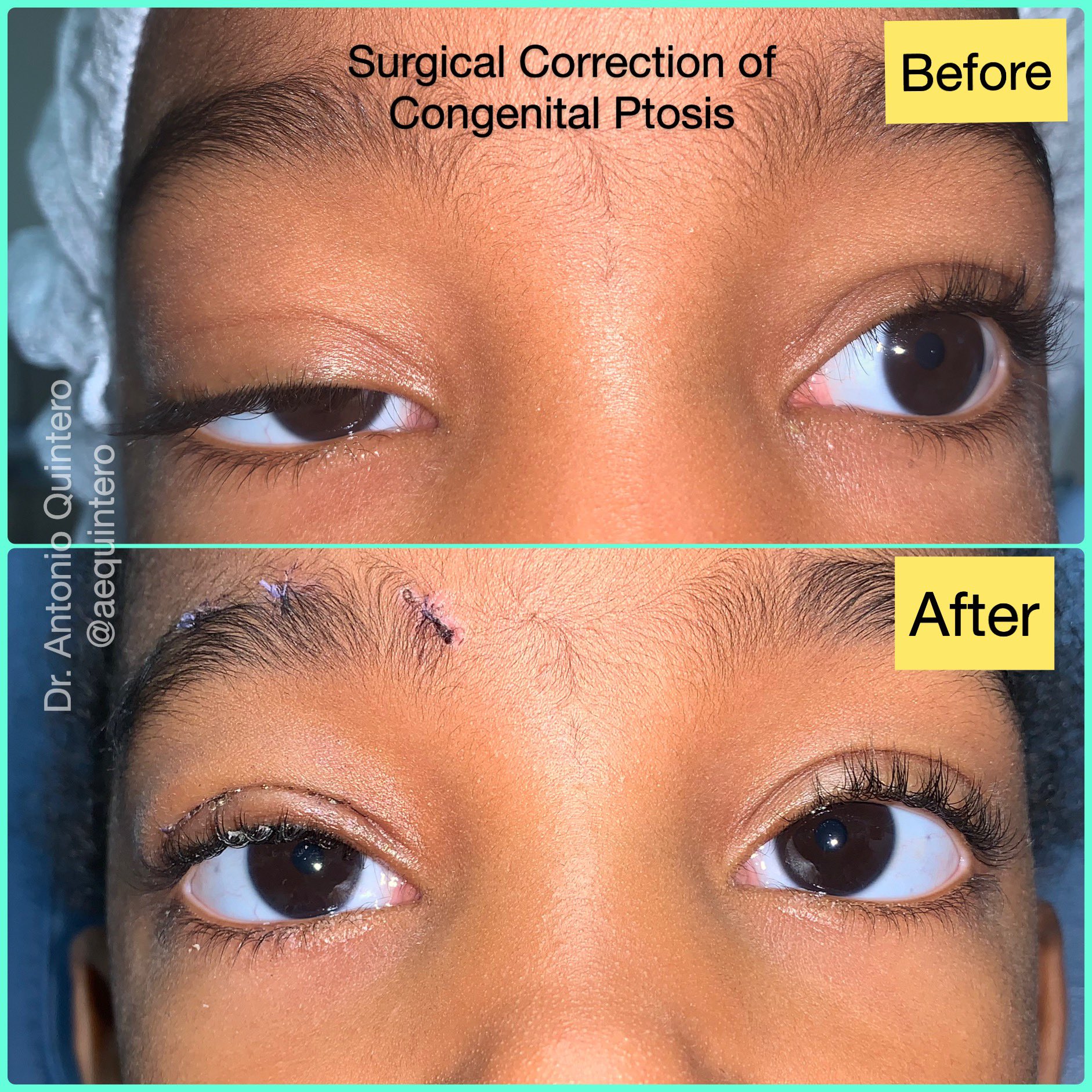 Congenital Ptosis