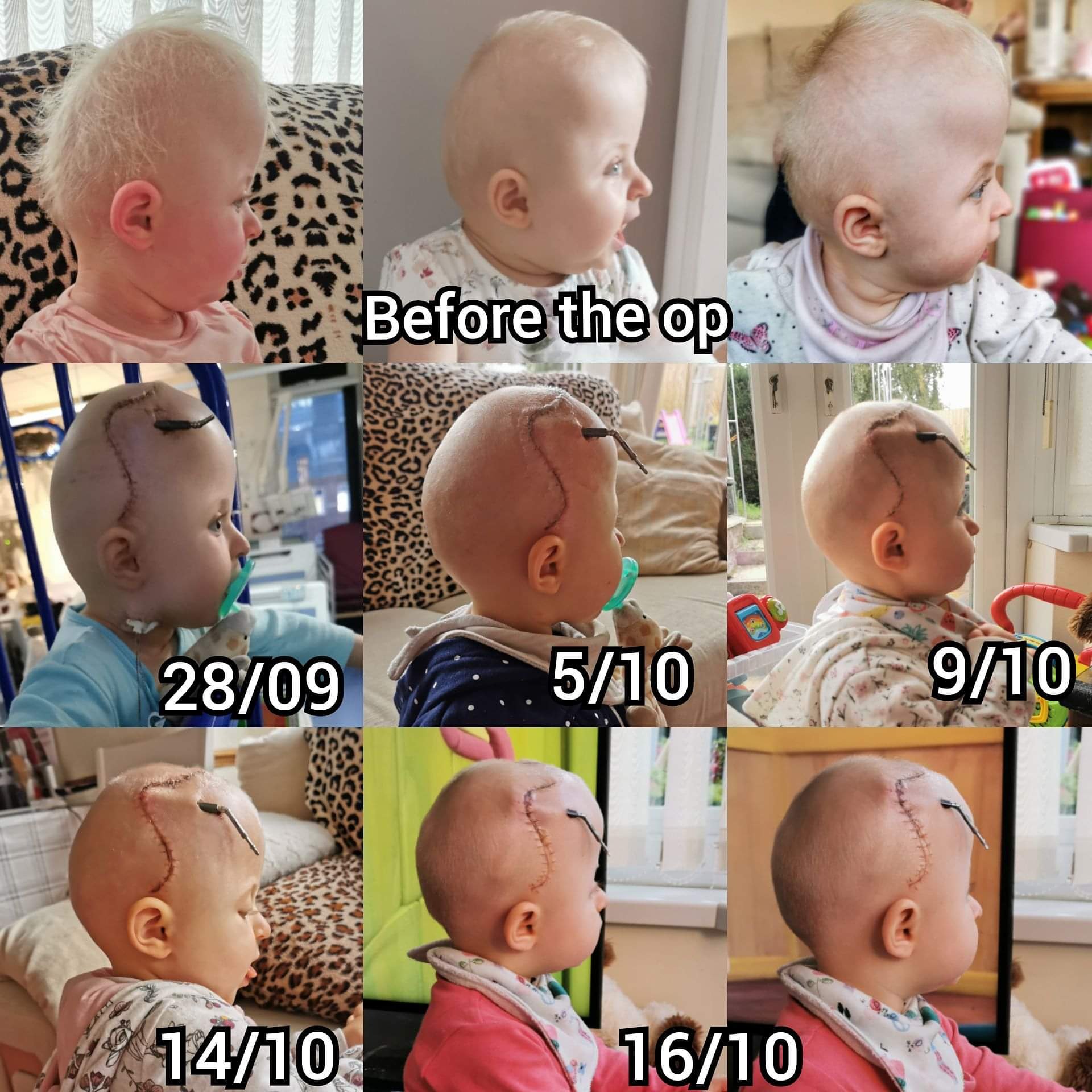 Bilateral Coronal Craniosynostosis