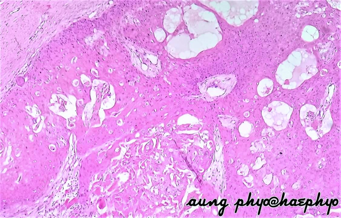 Proliferating Pilar Cyst