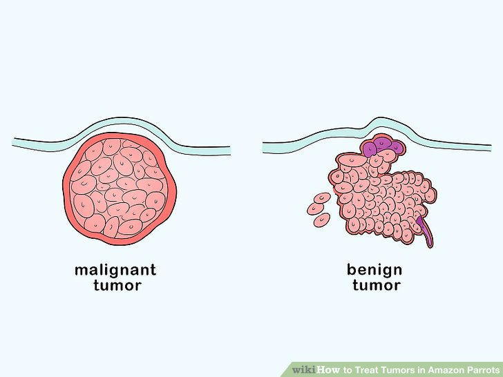 Malignant Tumor Vs Benign