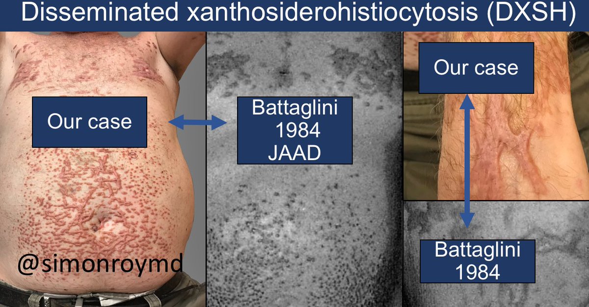 Xanthoma Disseminatum
