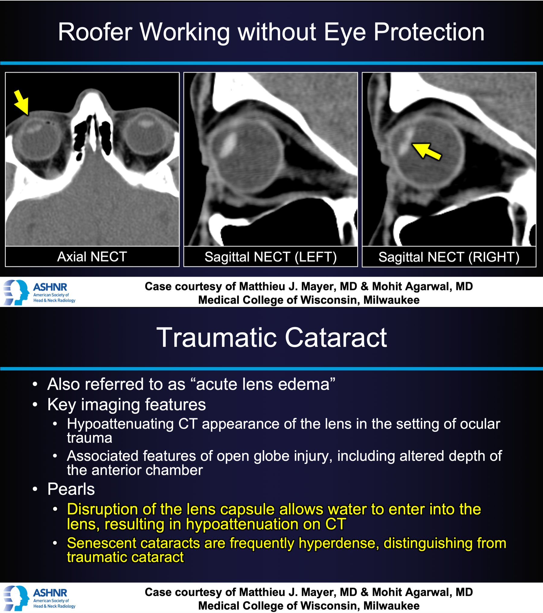 Traumatic Cataract