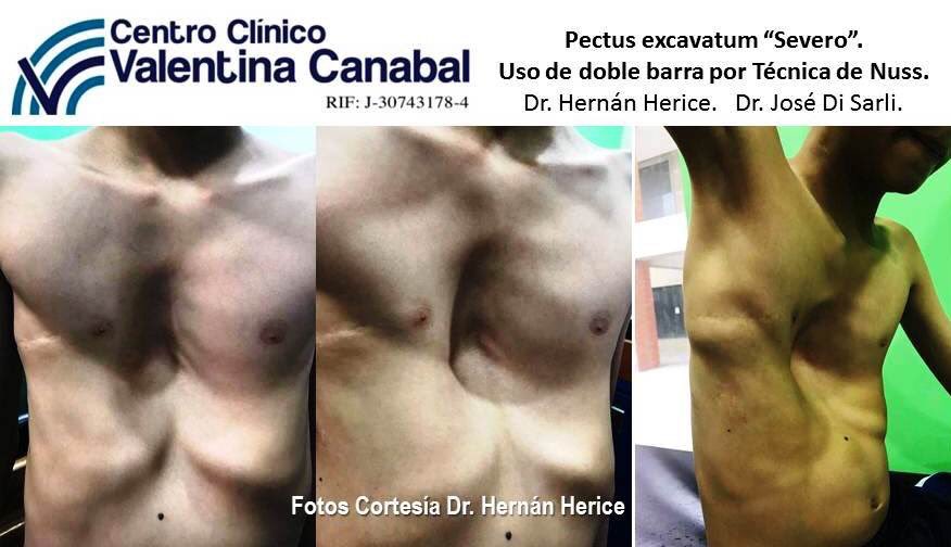 celebrar Resignación Colapso barra pectus excavatum contacto Hormiga ...
