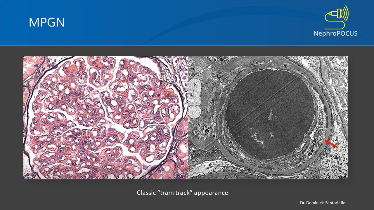 Membranoproliferative Glomerulonephritis Em