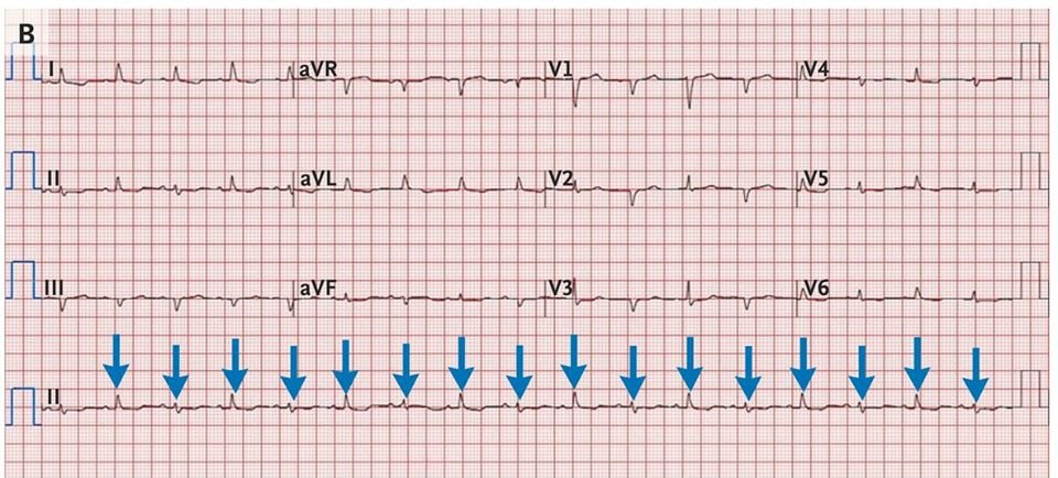 Electrical Alternans