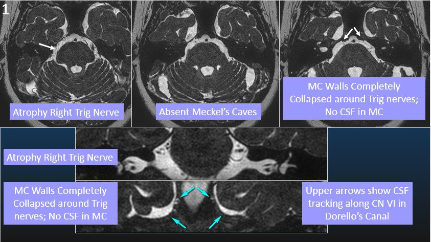 Meckels Cave Mri Anatomy