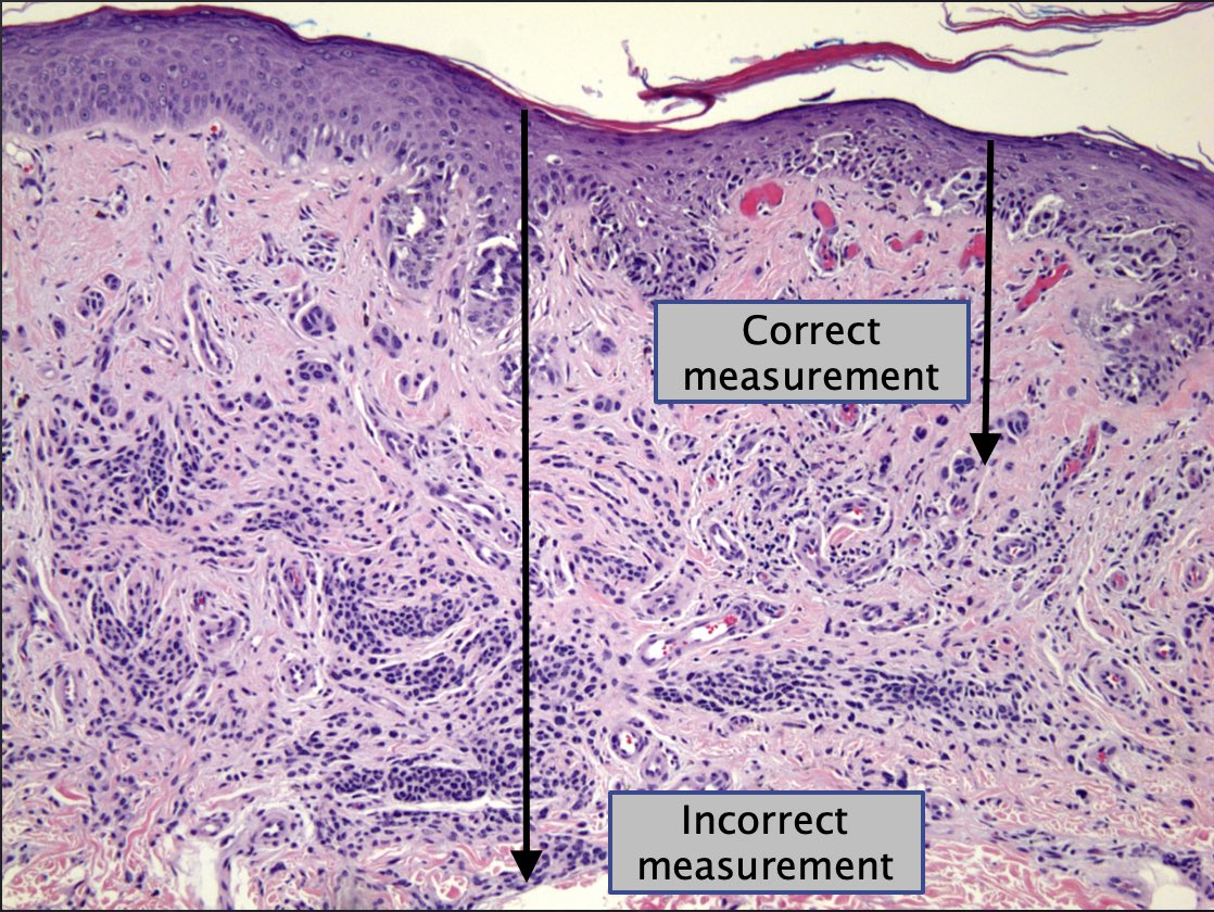 Invasive Melanoma Histology