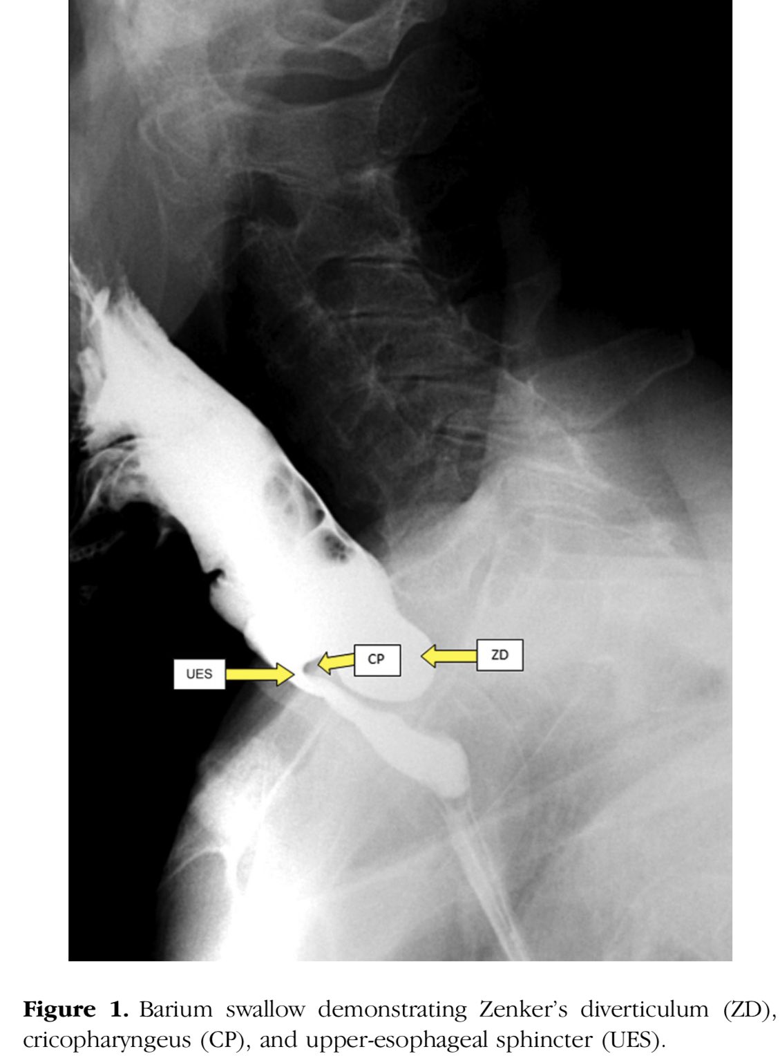 Zenkers Diverticulum Xray